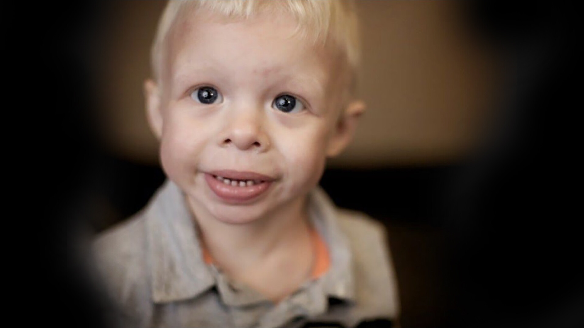 U01.01.068 Williams Syndrome MCQs: Chromosome 7q11.23 Deletion & Elfin ...